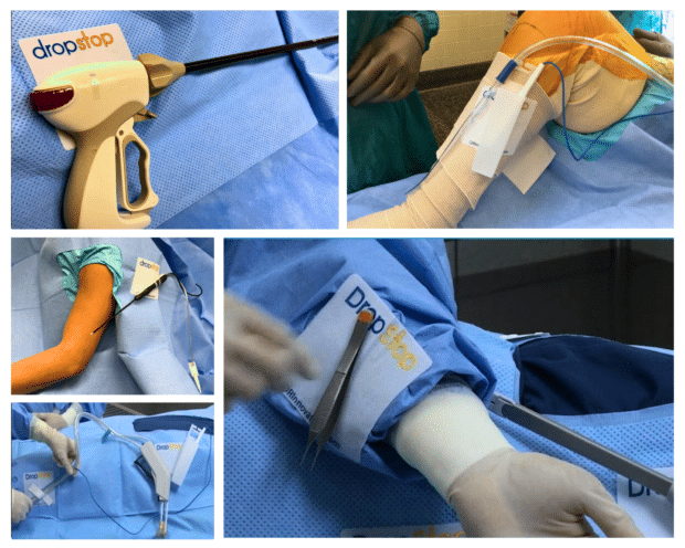 DropStop® Securing Kit – Operating Room Innovations