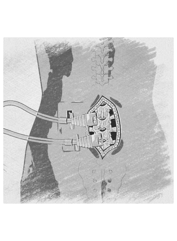 SmokeStop™ – Operating Room Innovations