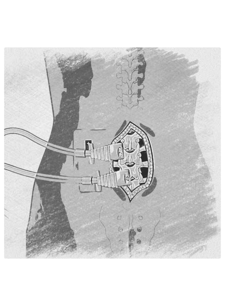 SmokeStop™ – Operating Room Innovations